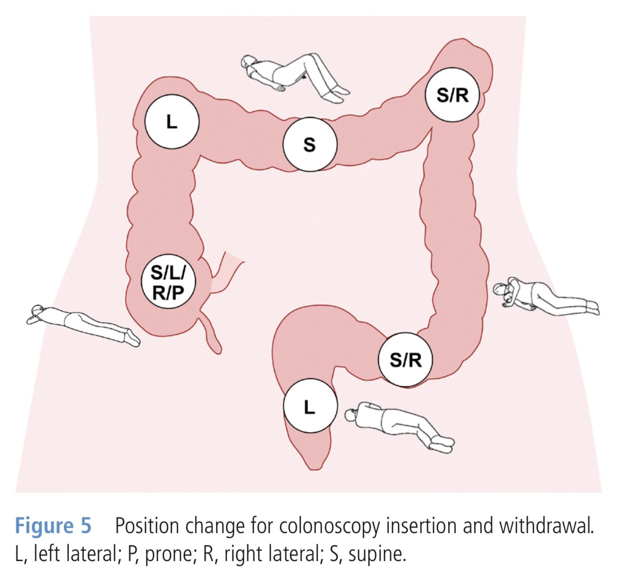 Colonoscopy Sitting Position JJ's Stage 4 Colorectal Cancer Story
