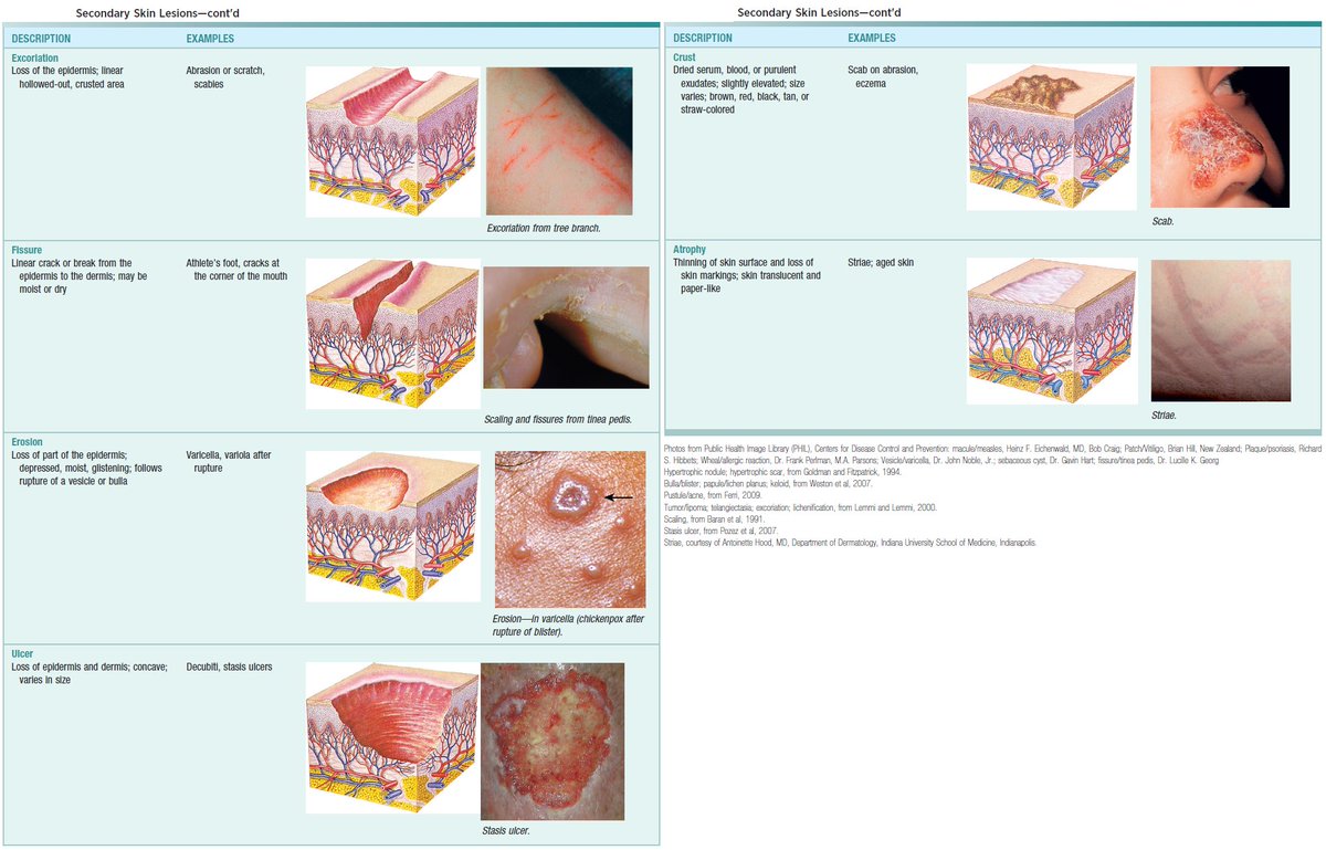 Erosion Skin Vs Ulcer