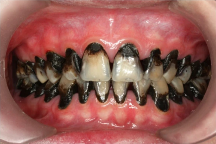 Permanent Silver Teeth