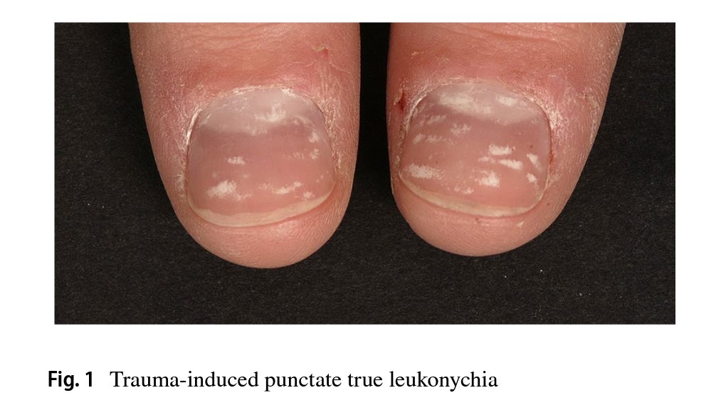 True Leukonychia