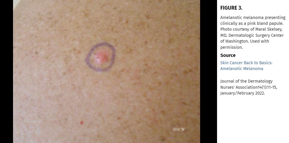 Amelanotic Melanoma