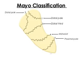 Scaphoid Fracture Classification