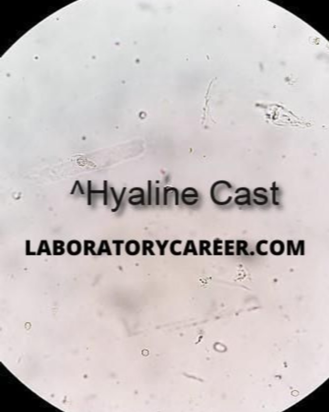 Hyaline Casts In Urine