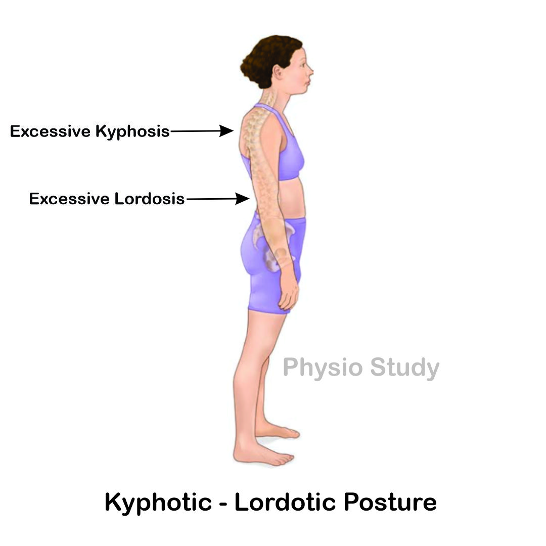 Kyphotic Posture