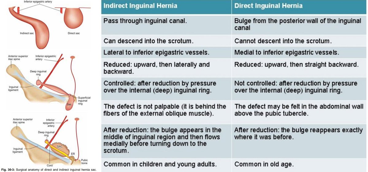 Direct Vs Indirect Hernia Direct Vs Indirect Hernia