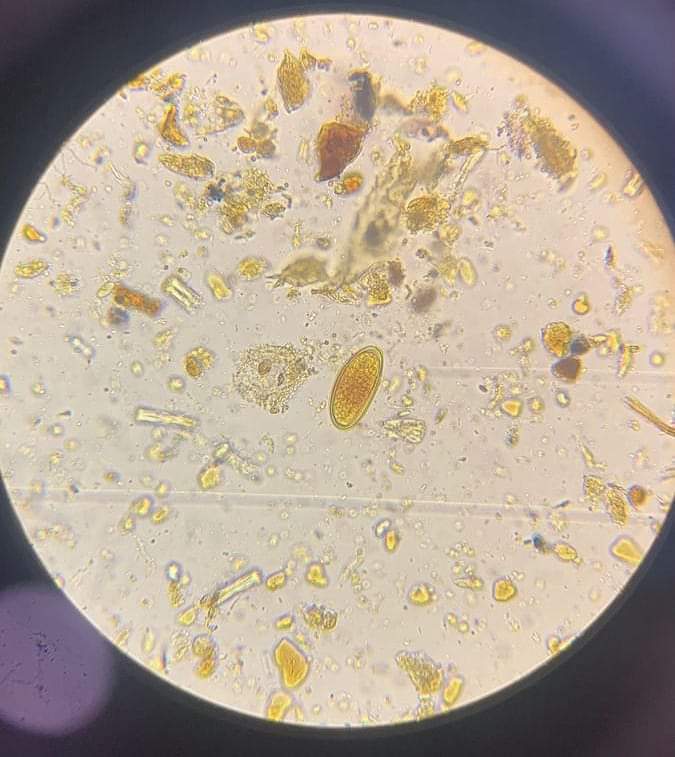 Enterobius Vermicularis In Stool