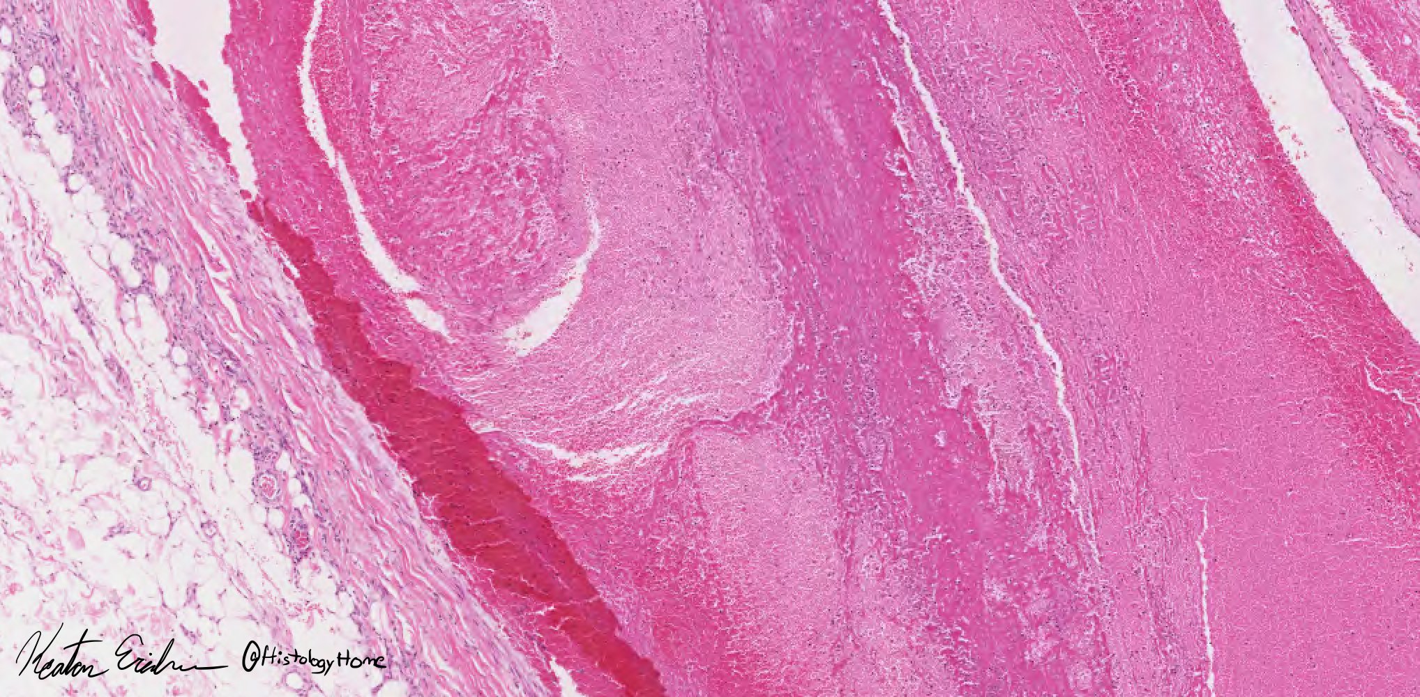 Fibrin Histology