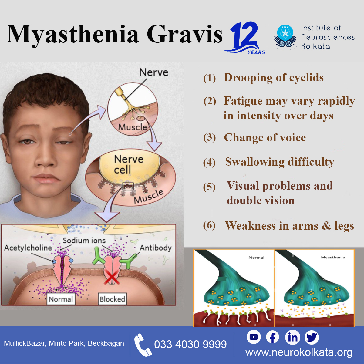 Myasthenia Gravis In Children
