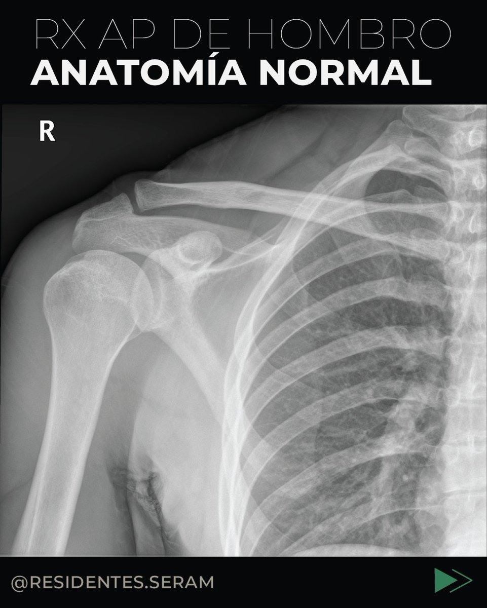 Hombro Normal De Rayos X