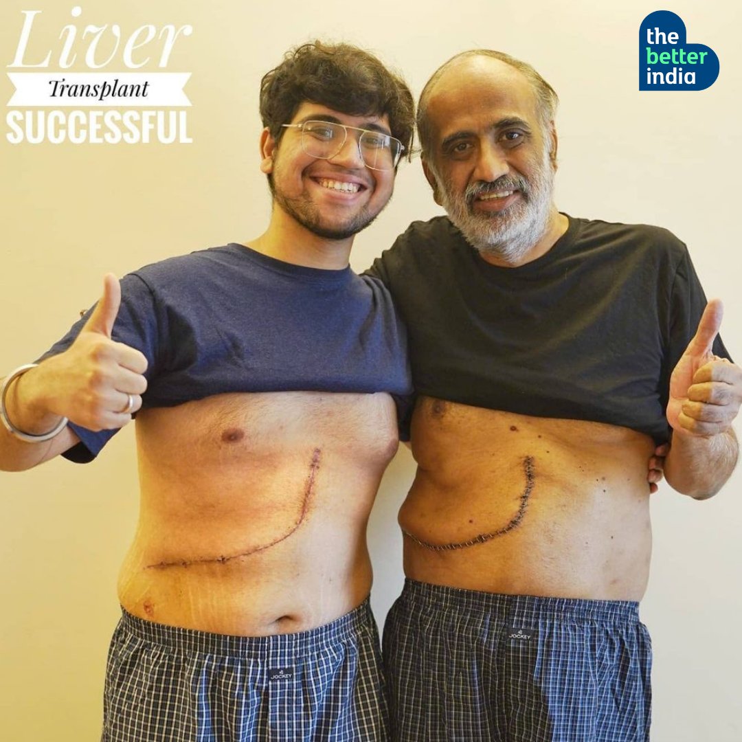 Liver Transplant Scar