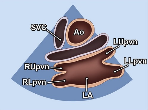 Suprasternal aortic view #POCUS #anatomy - used in the evaluation of ...