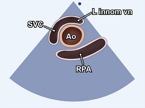 Suprasternal aortic view #POCUS #anatomy - used in the evaluation of ...