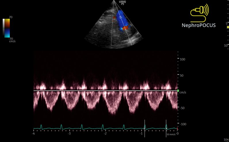 Suprasternal aortic view #POCUS #anatomy - used in the evaluation of ...