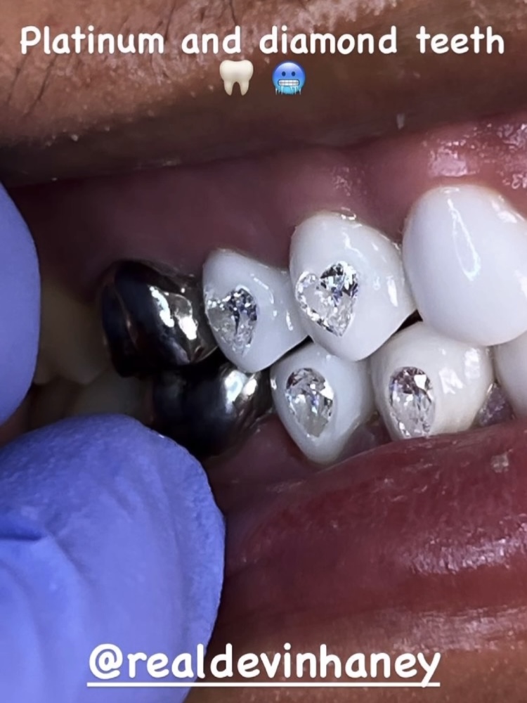 Platinum Teeth With Diamonds Nasherz Gold Grillz Birmingham, UK