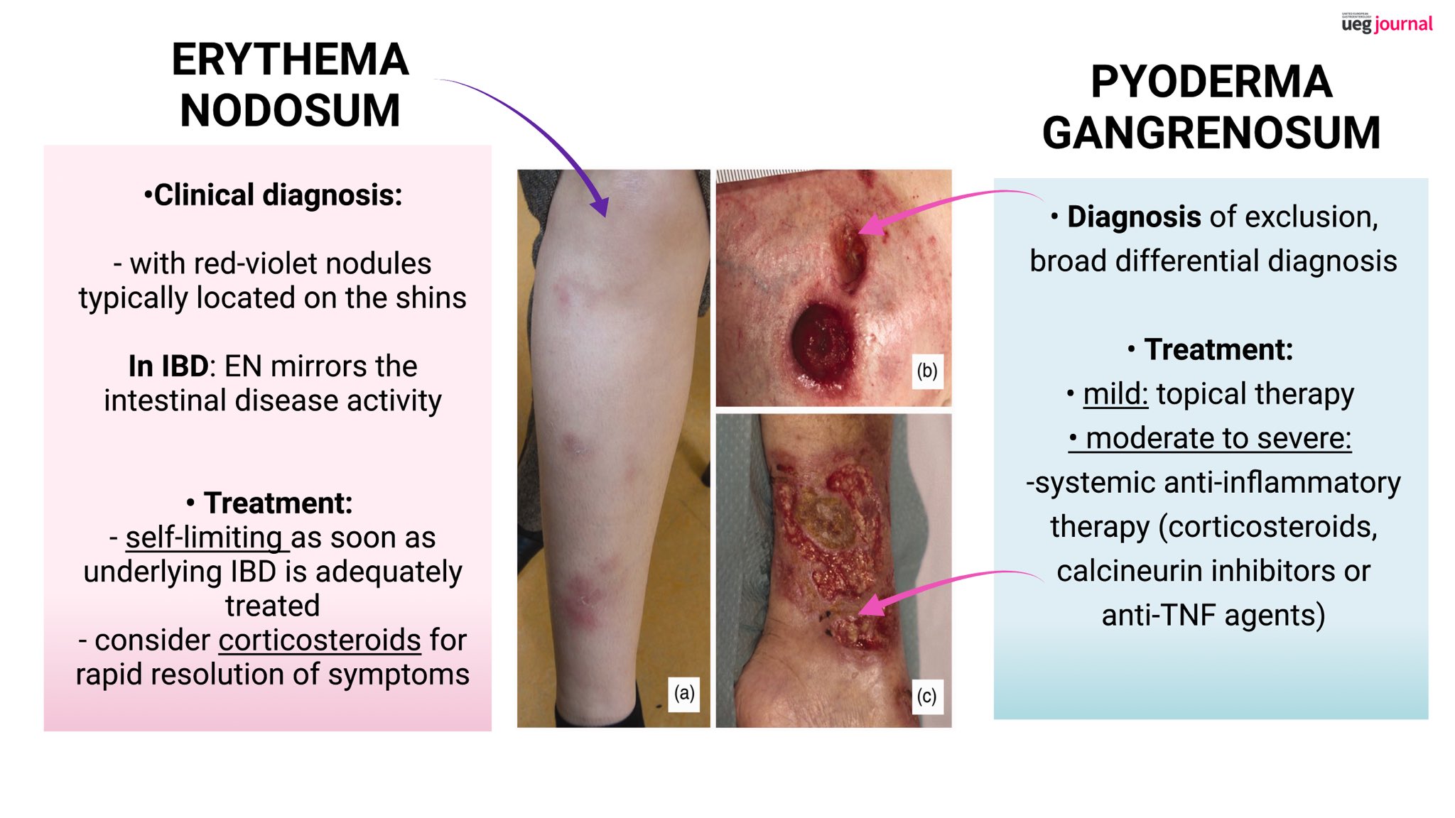 Mild Pyoderma Gangrenosum