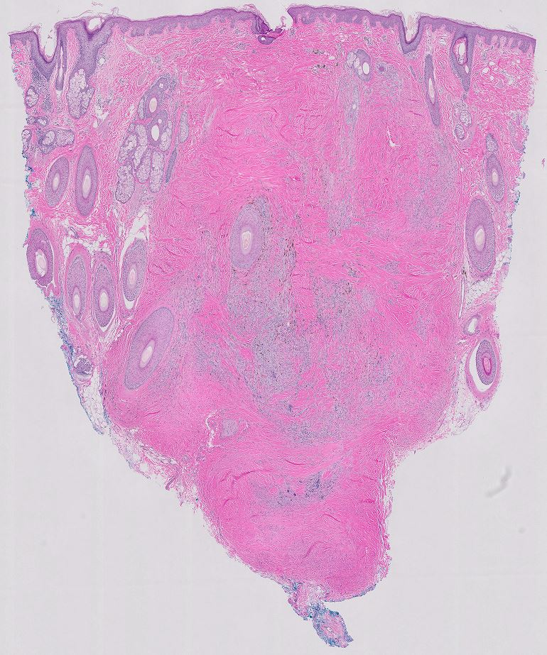 Blue Nevus Histology