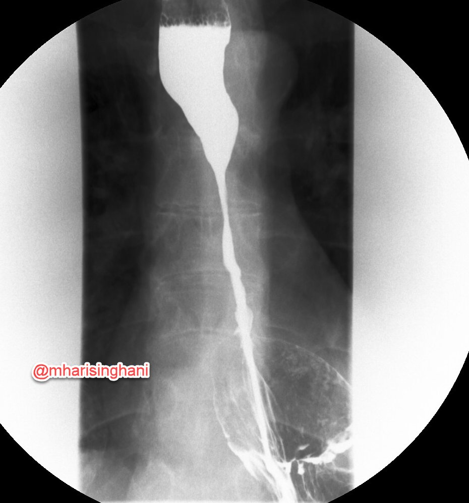 Esophageal Stricture Barium Swallow