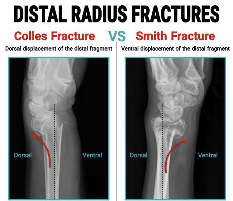 Smith Fracture X Ray