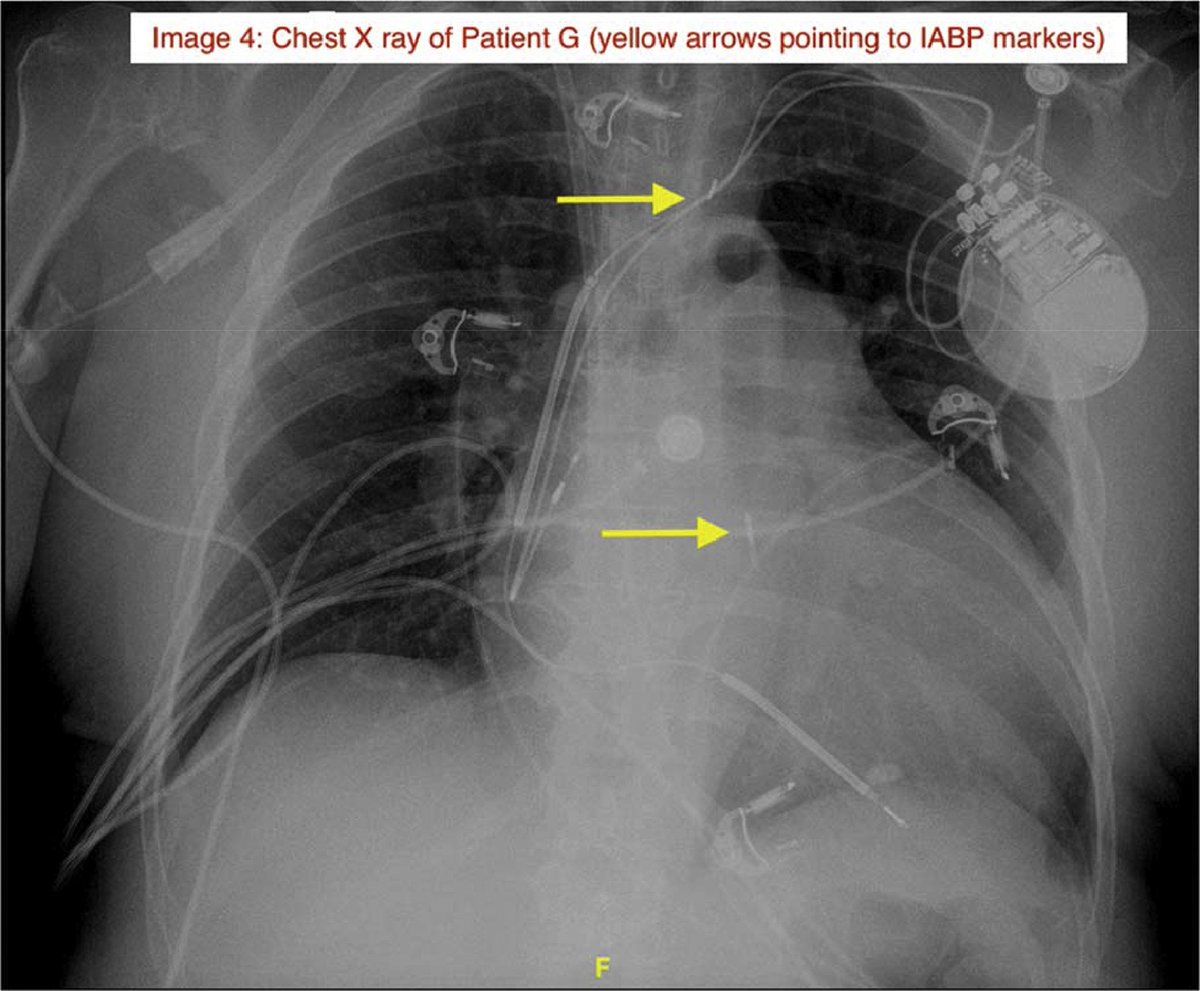 Whats Going On With The Intra Aortic Balloon Pump Iabp Heres A