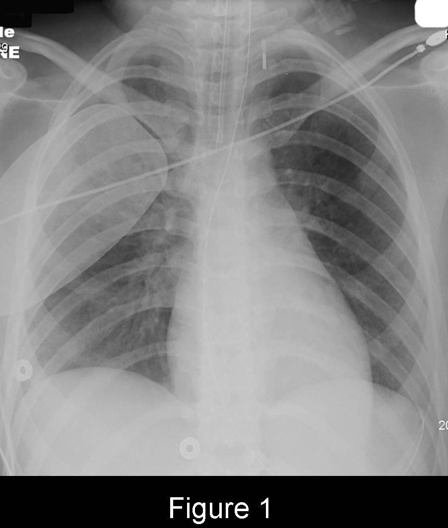 What's going on with the intra-aortic balloon pump (IABP)? Here's a ...