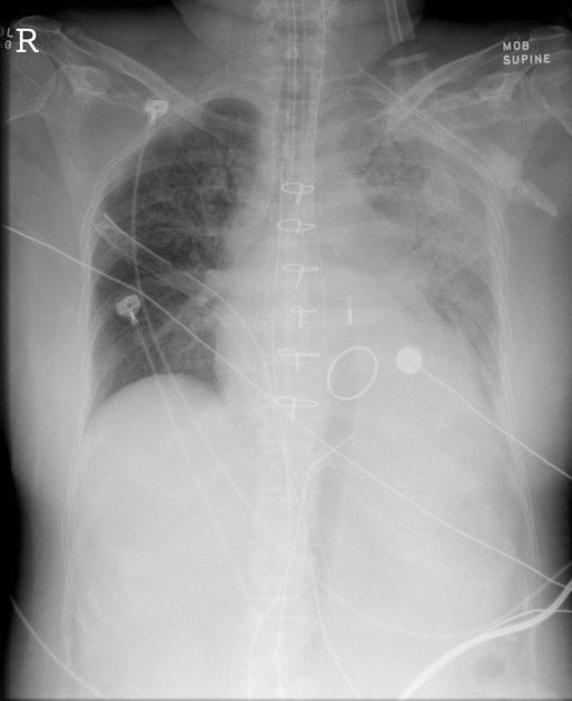 What's going on with the intra-aortic balloon pump (IABP)? Here's a ...