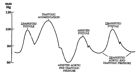 What's going on with the intra-aortic balloon pump (IABP)? Here's a ...