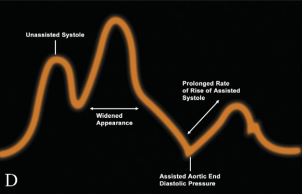 What's going on with the intra-aortic balloon pump (IABP)? Here's a ...