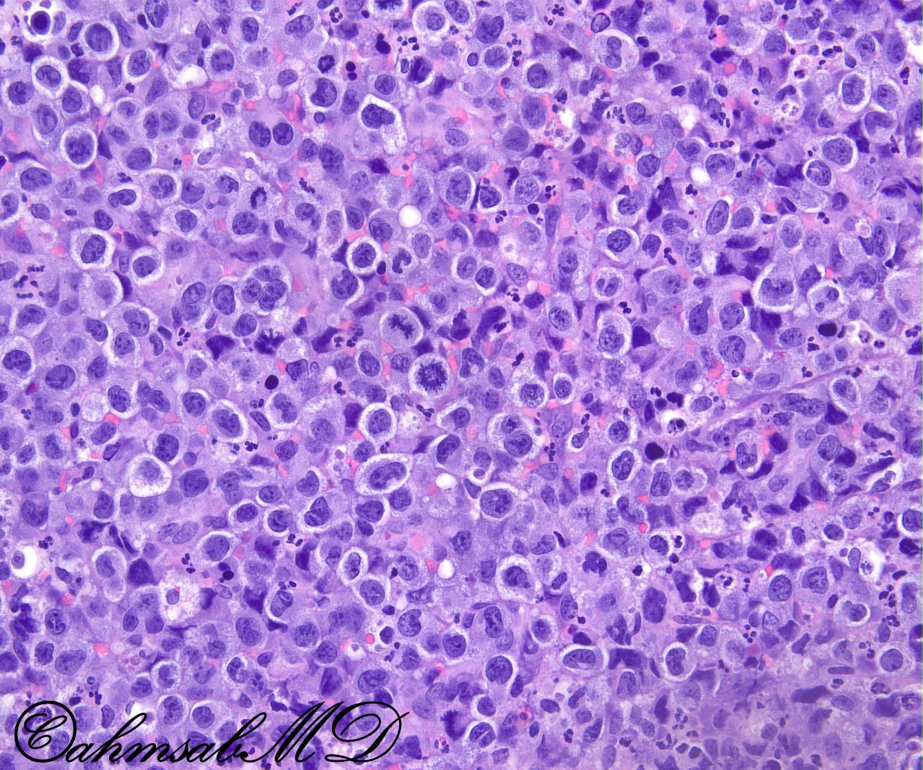 Anaplastic Large Cell Lymphoma Hallmark Cell