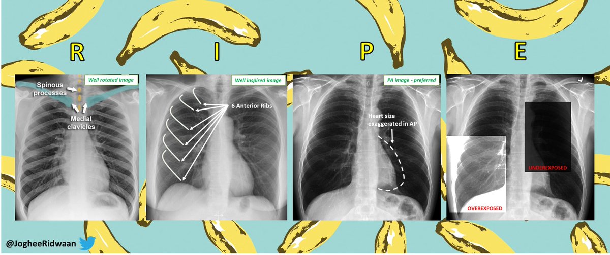 Ripe Abcde Chest X Ray at Lily Bolton blog
