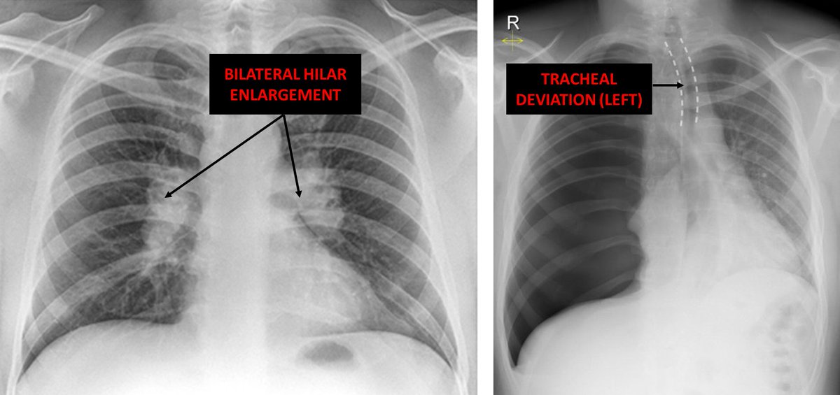 1/19 🧵 Are you struggling to understand and interpret chest X-rays? If ...