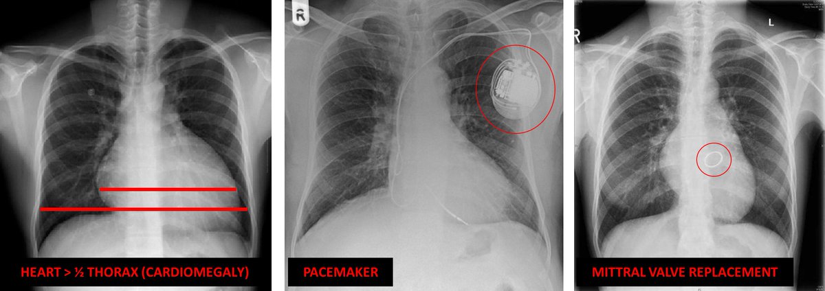 1/19 🧵 Are you struggling to understand and interpret chest X-rays? If ...