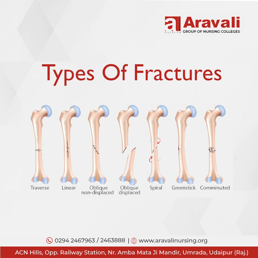 Complicated Fracture
