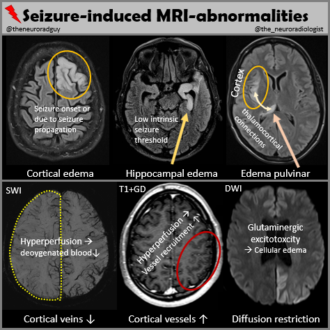 Epilepsy Brain Mri