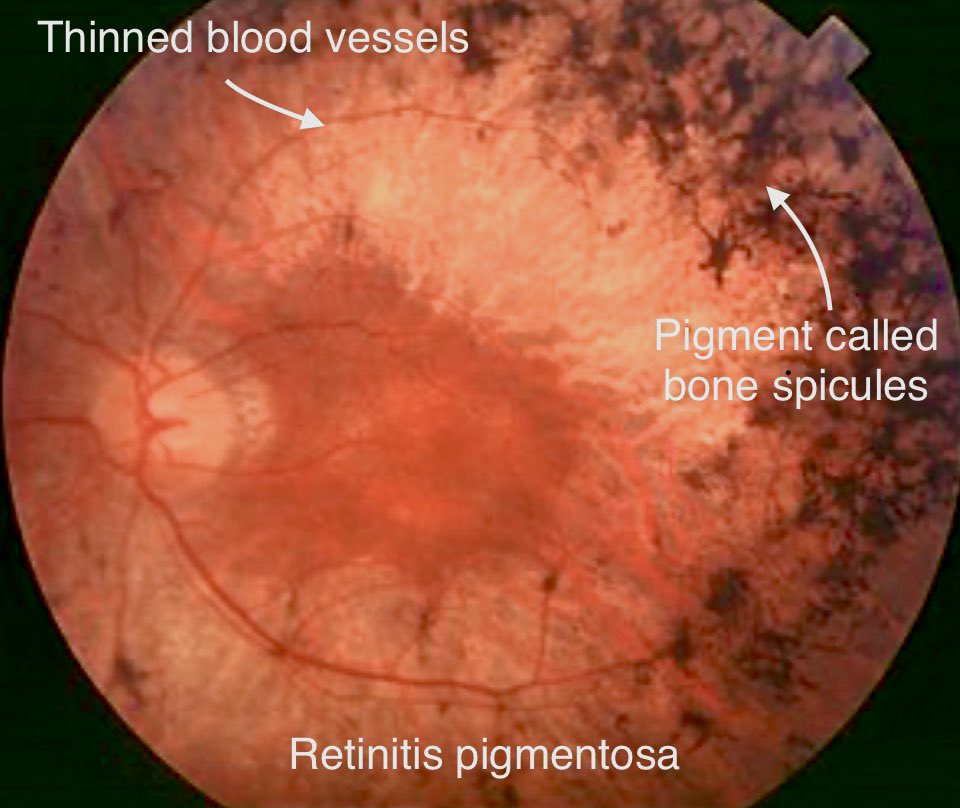 Retinitis Pigmentosa Before And After