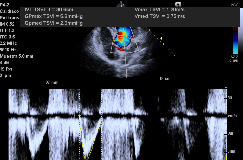 #AKIConsultseries 40 y ♂️ with advanced liver Cirrhosis (Secondary ...