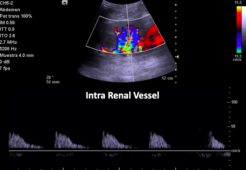 #AKIConsultseries 40 y ♂️ with advanced liver Cirrhosis (Secondary ...