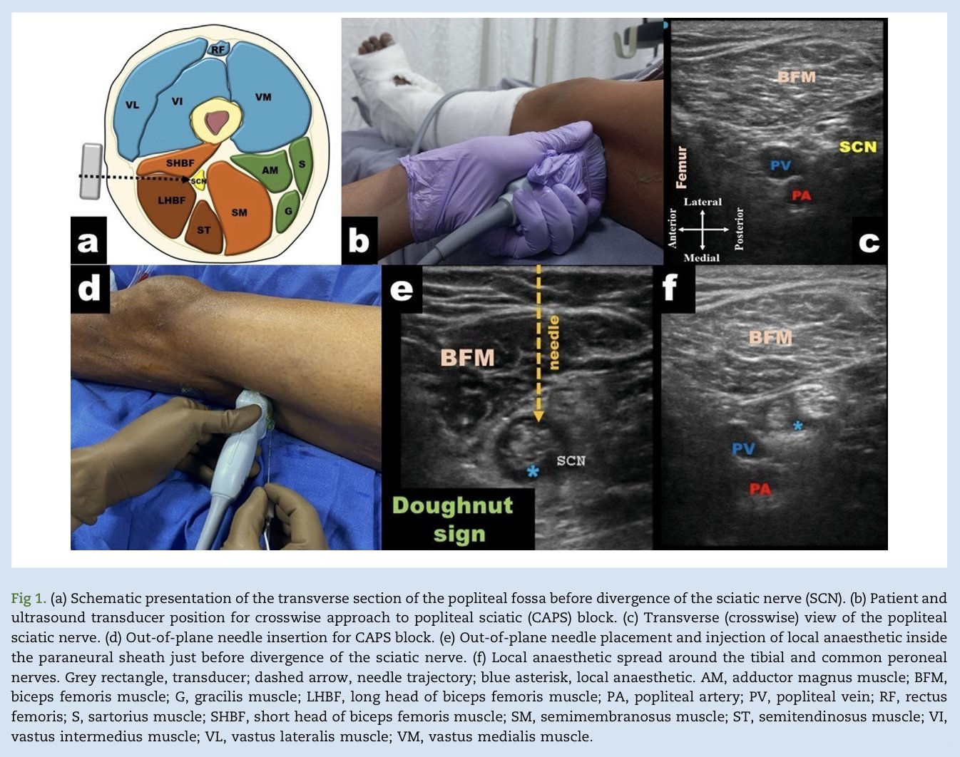 Sciatic Nerve Block Anterior Approach