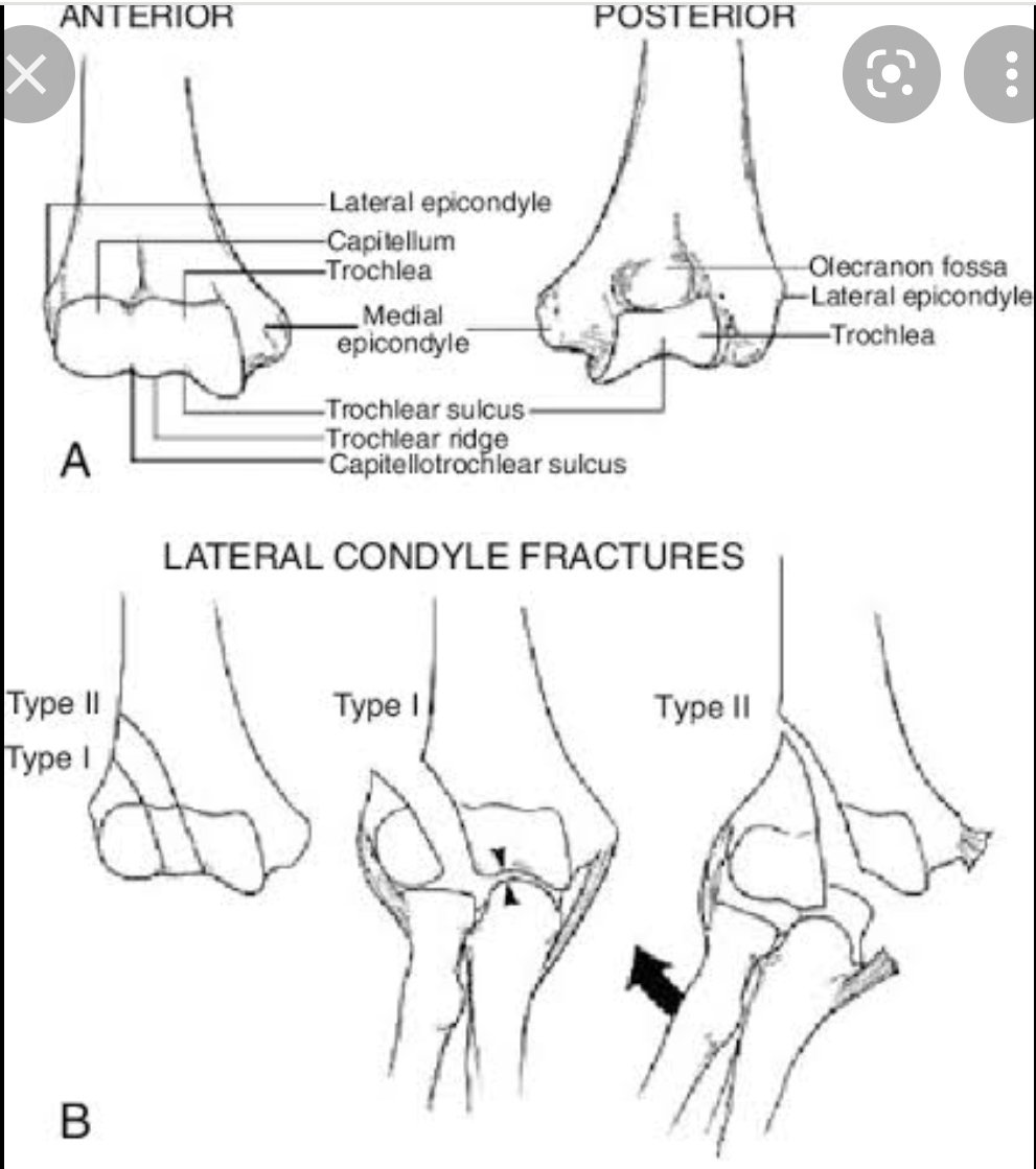 Lateral Condyle Fracture Milch