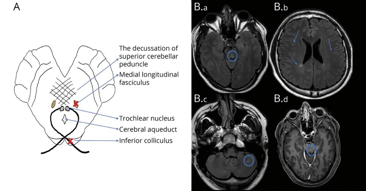 Medial Longitudinal Fasciculus Mri