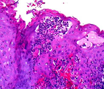 Pyostomatitis Vegetans Histology