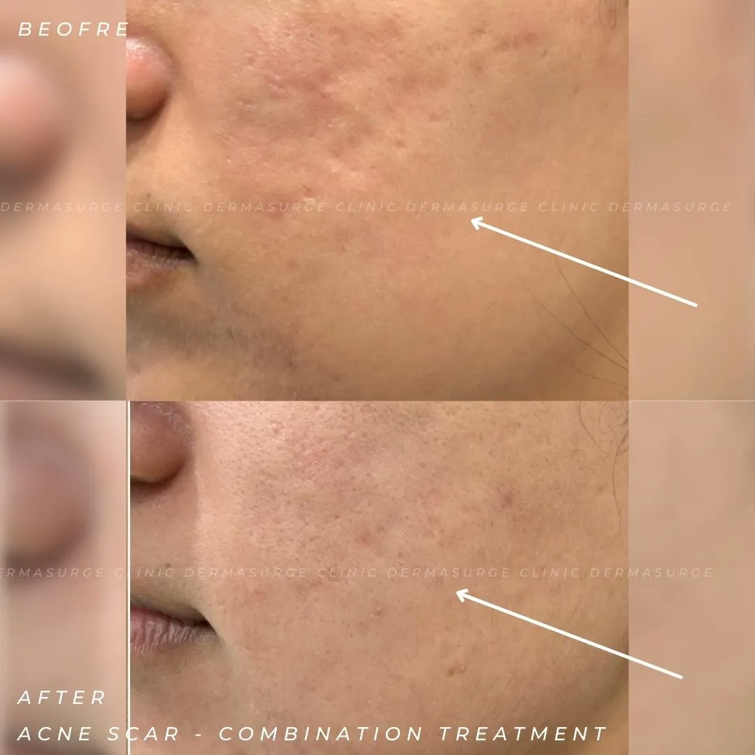 Acne Scars Before And After Laser