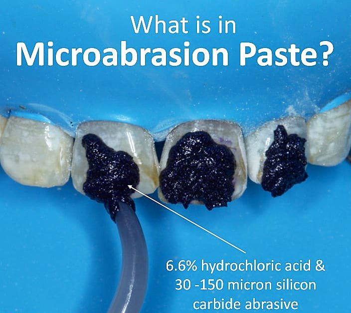 Microabrasion is a conservative option for removing surface ...