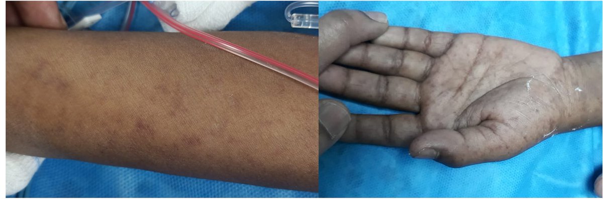 Case1 7 yr/M presented with fever & vomiting x 4 days, altered ...