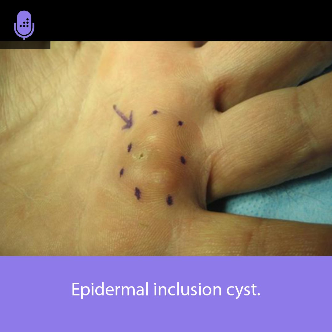 Inclusion Cysts