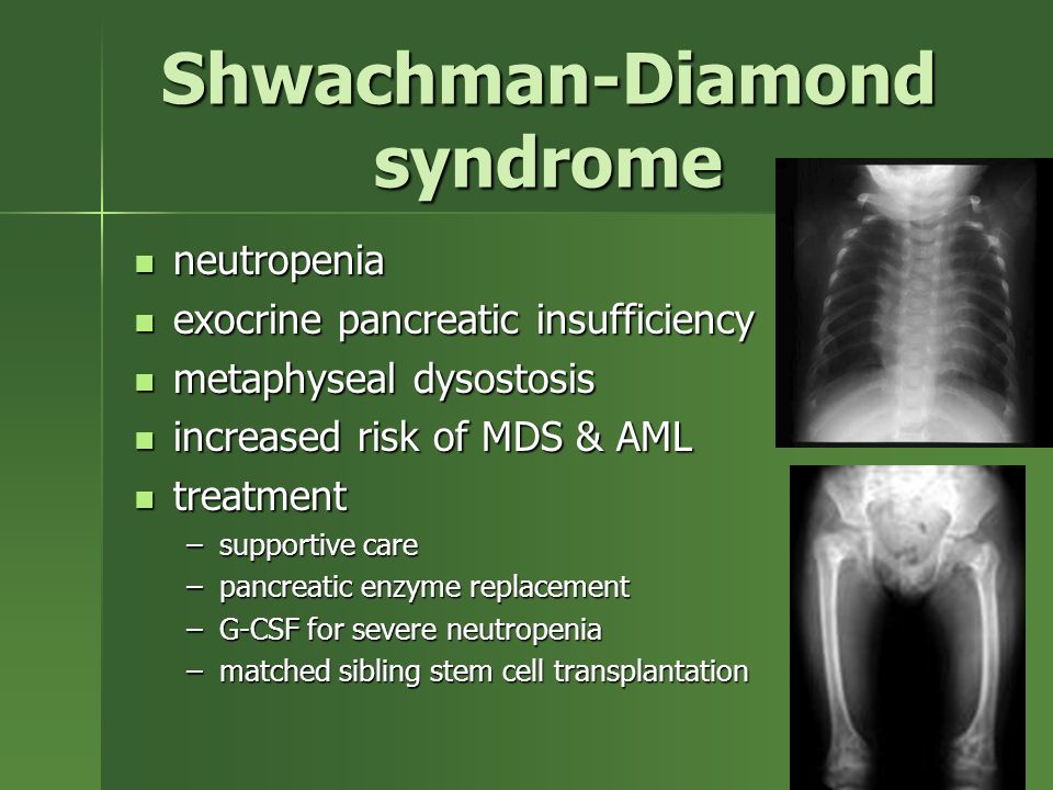 Shwachman Diamond Syndrome