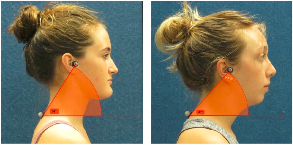 Forward Head Posture Before And After Forward Head Posture Correction