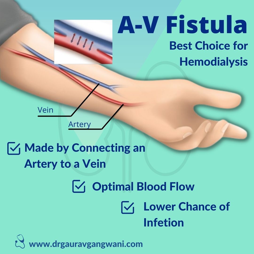 Types Of Av Fistula For Dialysis