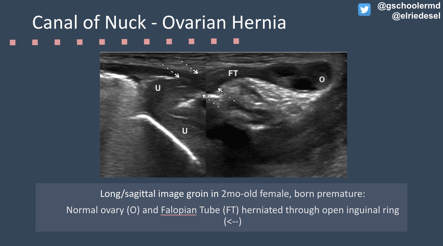 Inguinal Hernia Female Ultrasound