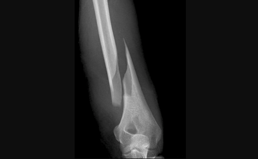 4. Tipos de fracturas