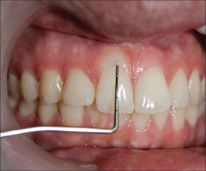Methods of assessing gingival biotype #Dental_by_Hadeel - Thread from ...